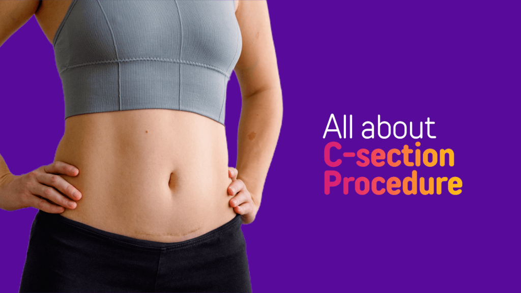 C-Section Delivery - What You Should Expect?